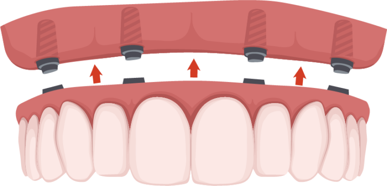 All-On-X Dental Implants – Mountain Dental